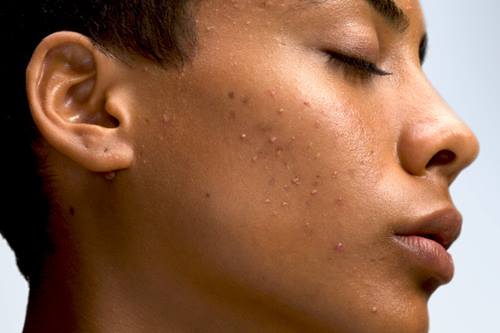 Type 2 Diabetes Skin Symptoms