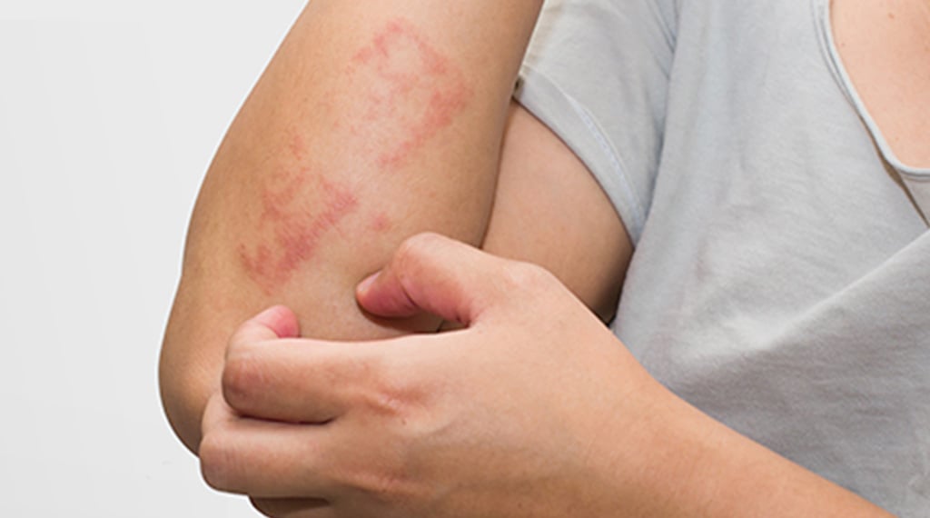Eczema On Elbows