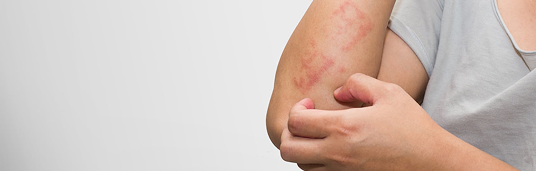 Dyshidrotic Eczema Arms