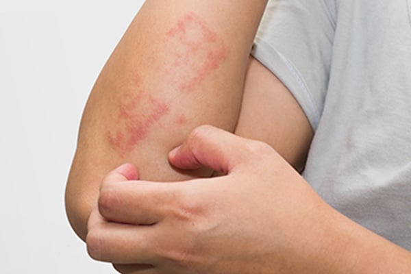 Dyshidrotic Eczema Arms