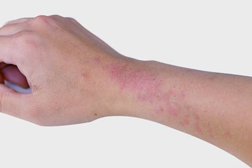 Diabetic Sores On Legs: Causes, Diagnosis, And Prevention