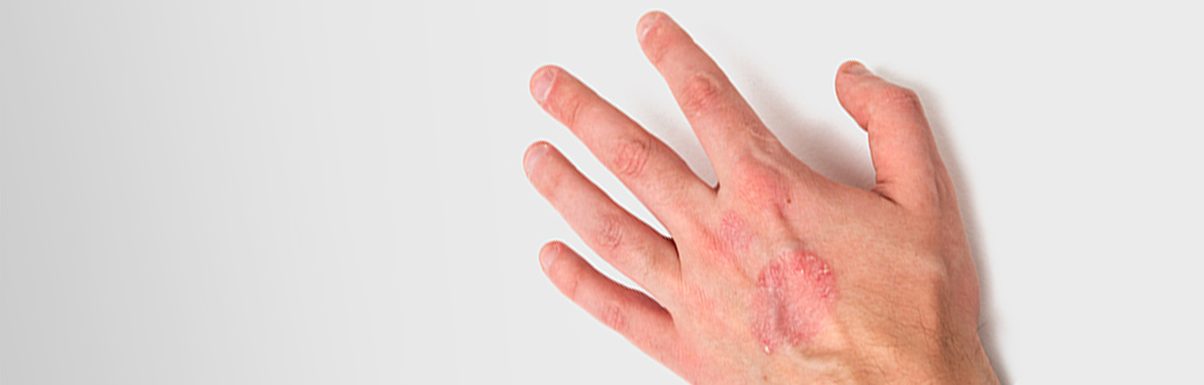 Mild Psoriasis On Hands