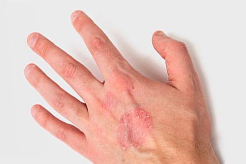psoriasis wrist