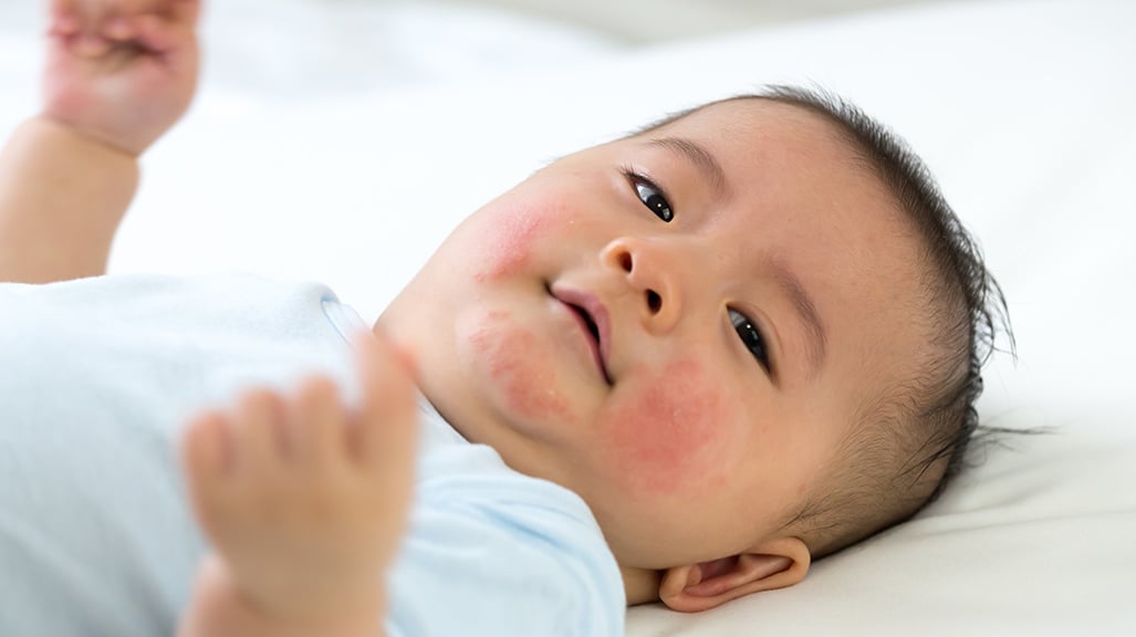 Heat Rash On Face Baby