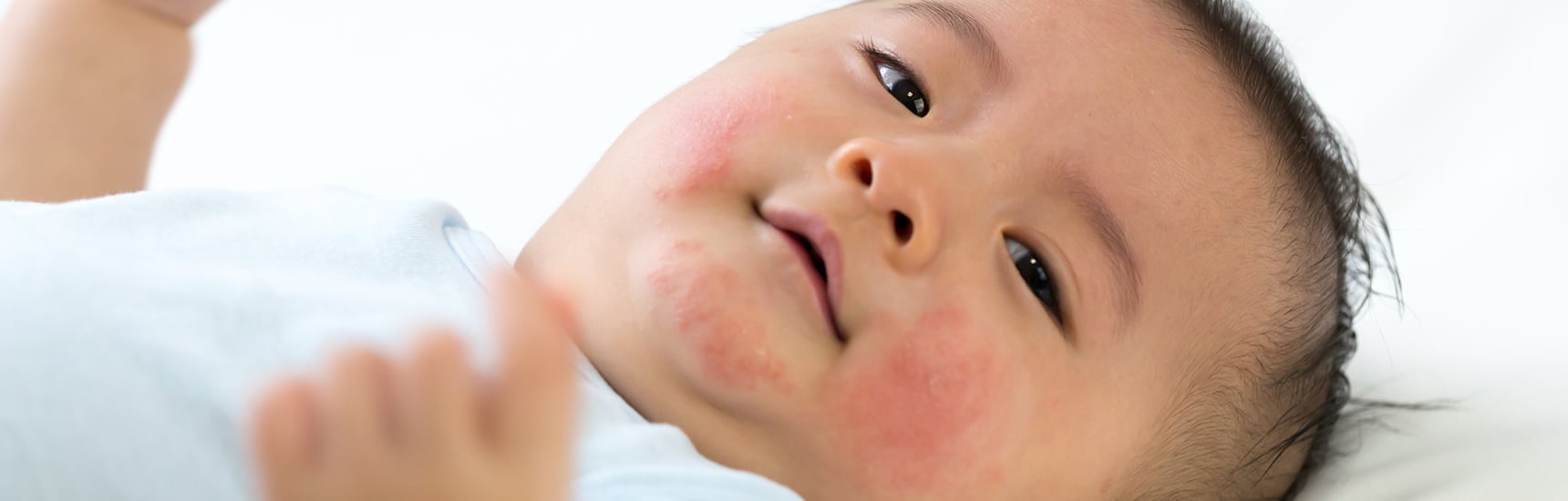 Heat Rash On Babies Face