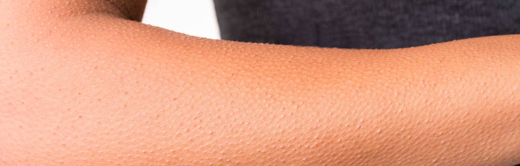 Bumpy Rash On Forearms