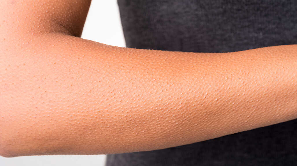 Keratosis Pilaris Forearms