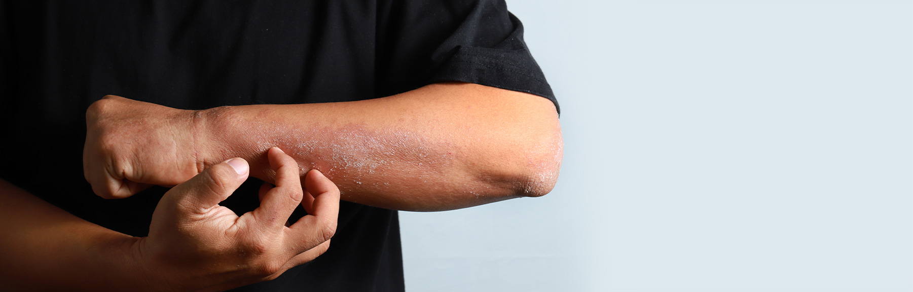 Dry Skin Patches On Elbows