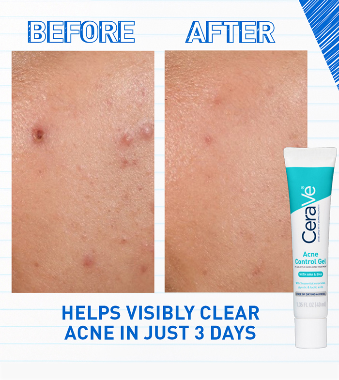 Acne Control Gel: Targeted Treatment | CeraVe