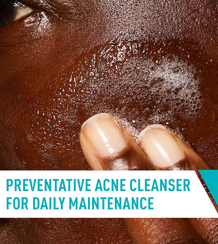Acne Control Cleanser | Salicylic Acid Treatment | CeraVe