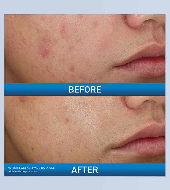 Acne Foaming Cream Wash with Benzoyl Peroxide | CeraVe