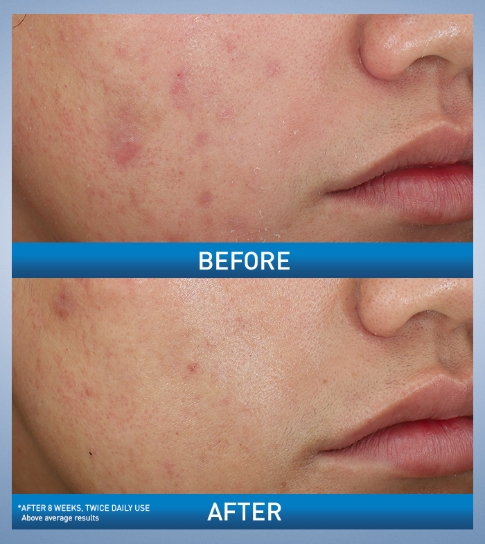 Acne Foaming Cream Wash | 10% Benzoyl Peroxide | CeraVe